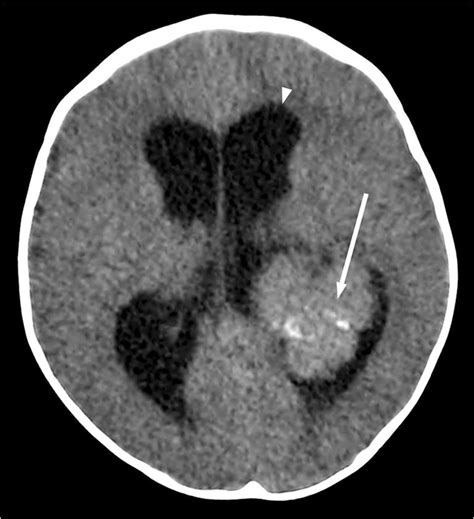 Choroid Plexus Papilloma In A 5 Year Old Boy Nonenhanced Ct Axial