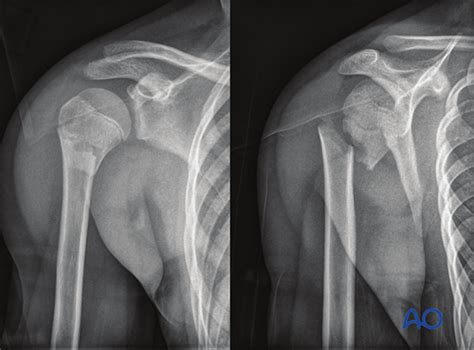 Highlights Of Pediatric Proximal Humerus