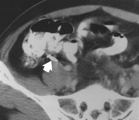 Ct Identification Of Abscesses After Dropped Appendicoliths During Laparoscopic Appendectomy Ajr