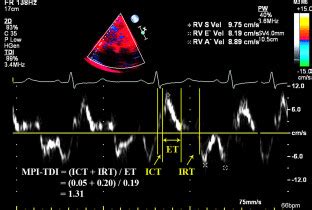 Myocardial Performance Index MPI Derived From Tricuspid Annular Download Scientific Diagram