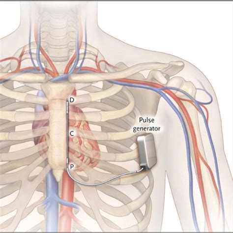 The Optimizer Cardiac Contraction Modulation System Download