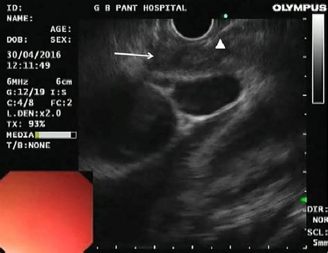 Endoscopy Biopsy Lymph Node At Douglas Byrd Blog