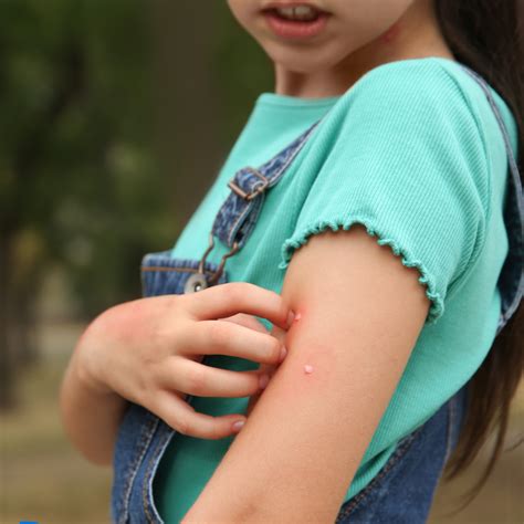 Searches For Nhs Advice On Insect Bites And Stings Increase Bsw Together