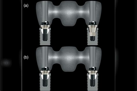 Evaluation Of Two Implant Supported Fixed Partial Denture Abutment Designs News American