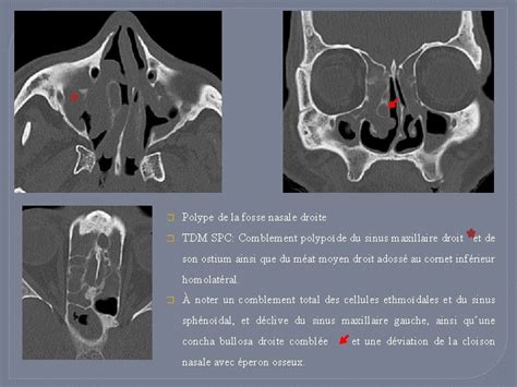Apport De La Tomodensitometrie Dans Le Polype De