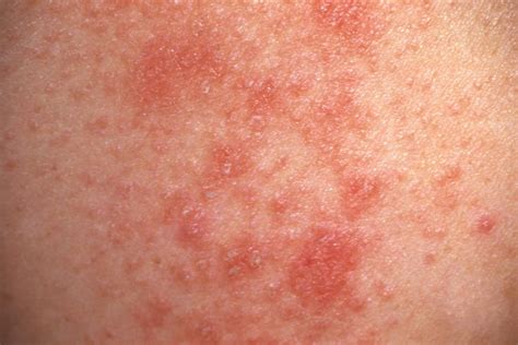Heat Rash Vs Eczema Symptoms Causes Treatment