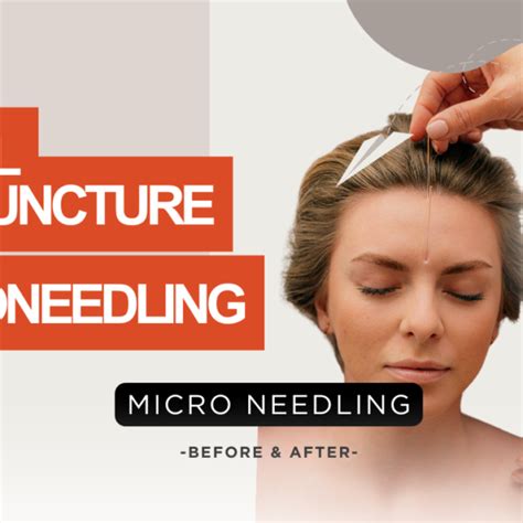 Microneedling Depth Chart