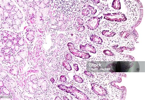 Histology Of Human Tissue Show Gastric Mucosa Intestinal Metaplasia As