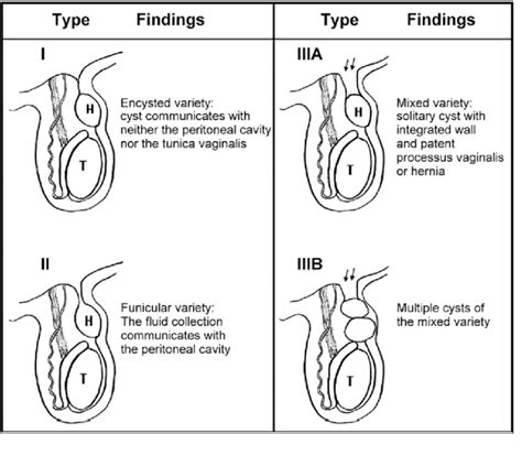 Figure 5 From Encysted Spermatic Cord Hydrocele A Case Series