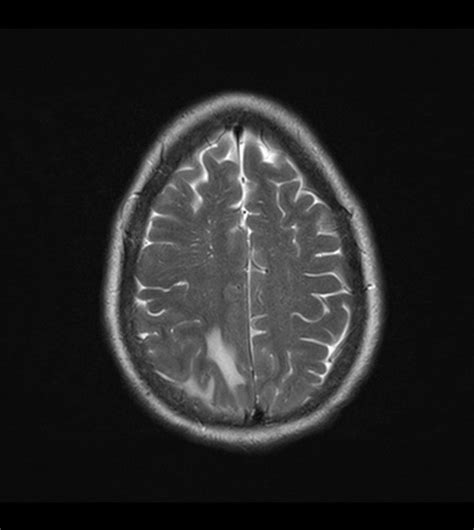 Brain Tumor Mri Classifications Classification Dataset And Pre Trained Model By Ehealth