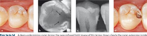 Figure 1 From Caries Detection And Diagnostics With Near Infrared Light Transillumination