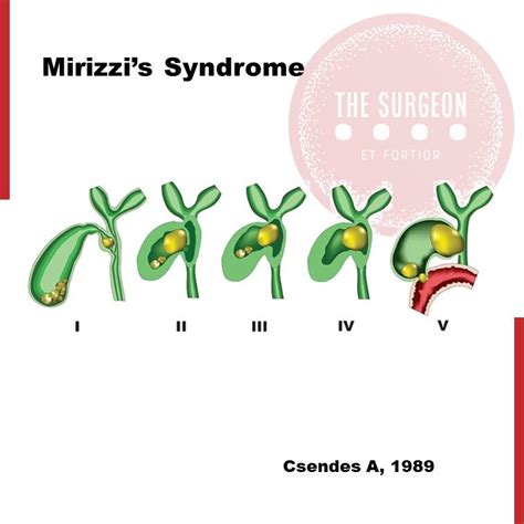 📊 Mirizzi S Syndrome Classification Csendes 1989 Types I V … Klaus Mönkemüller