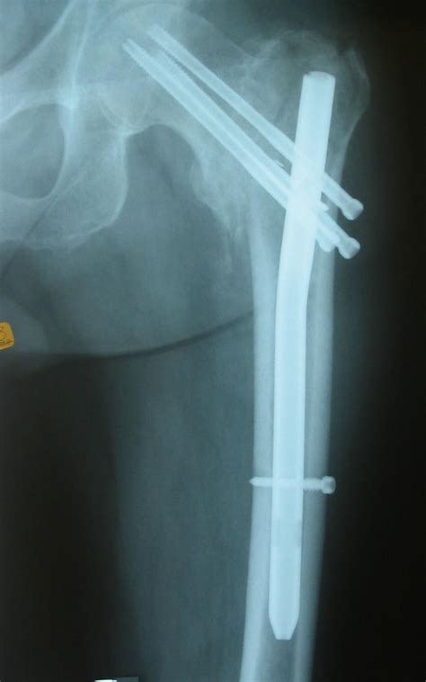 Intramedullary Nailing Simplified Model Of The IM Nail Left And The Third