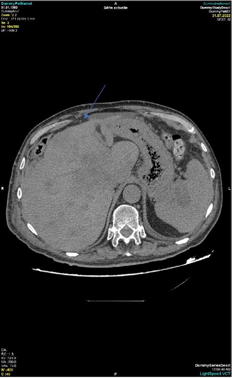 Ct Scan Showing Diffuse Hypodense Metastatic Nodules In The Liver And