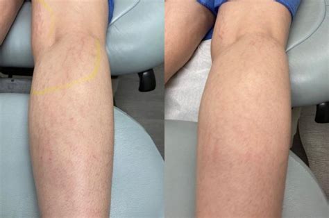 Stretch Mark Treatment Before And After Photo Gallery Houston Tx