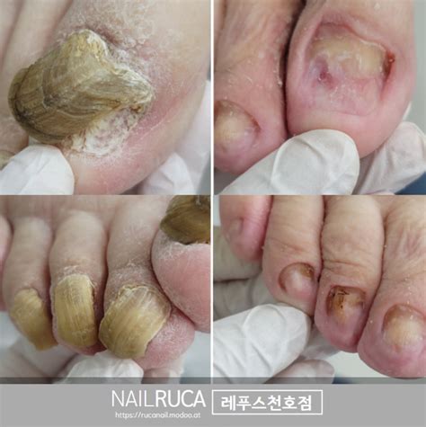 발톱무좀 초기증상 레이저 치료 가격 알려드립니다 네이버 블로그