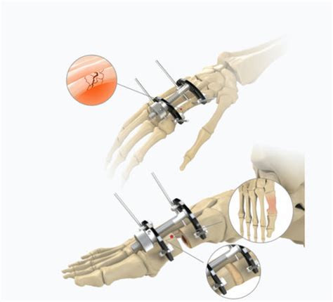 Metatarsophalangeal Joint External Fixation System 5784 0000 Zimed