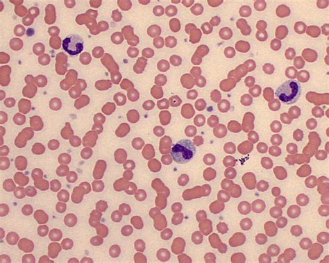 Inflammatory Leukogram In A Dog With Metritis Eclinpath