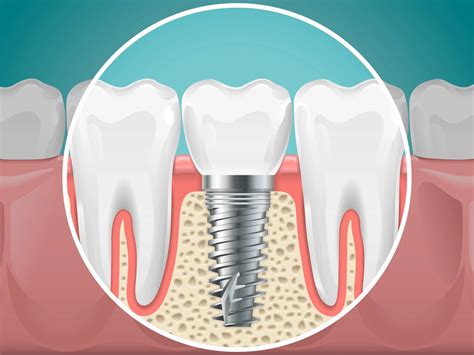 Individual Dental Implants Precision Tooth Replacement Solutions