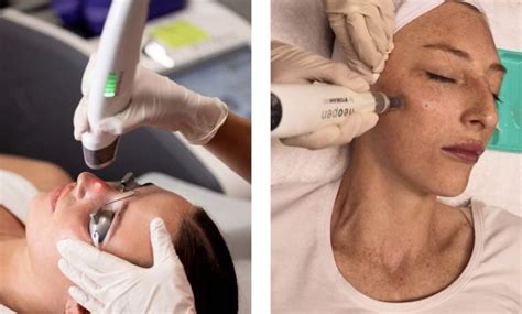 Cutera Genesis Laser And Skin Needling — Sanctuary Cosmetic Clinics