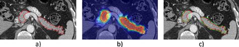 example of pancreas segmentation using the proposed r 2 − convnet ap