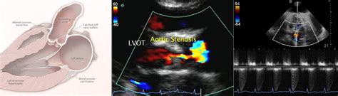 Valvular Emergencies Diagnosis And Management Of Severe Aortic
