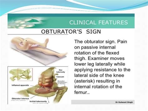 Psoas Sign Psoas Hip Flexor Stretch Active Isolated Stretching