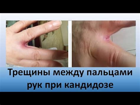 Зуд между пальцами рук: причины зуда кожи между пальцев рук