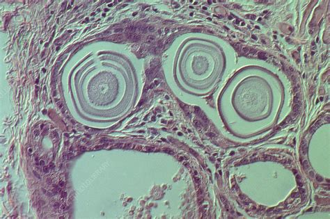 Close Up Of Breast Calcification Cells Stock Image F005 2465 Science Photo Library