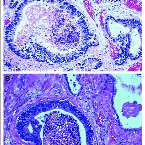 Gonococcal Urethral Stricture Retrograde Urethrogram Reveals A Segment