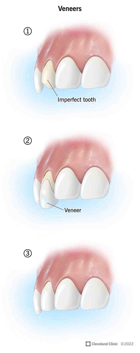 Do Veneers Come Off Dental News Network
