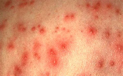 Hot Tub Rash Treatment Antibiotics Acsbr Nccsea