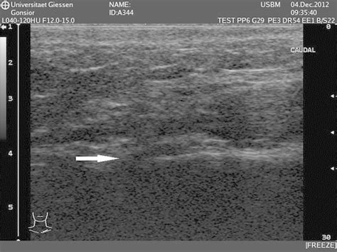 Sonogram Of The Left Clavicle Of A 17 Year Old Obese Man Due To The