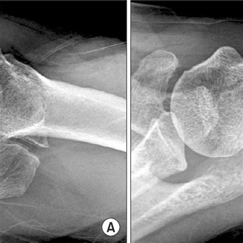 Pdf The Prevalence Of Os Acromiale In Korean Patients Visiting Shoulder Clinic