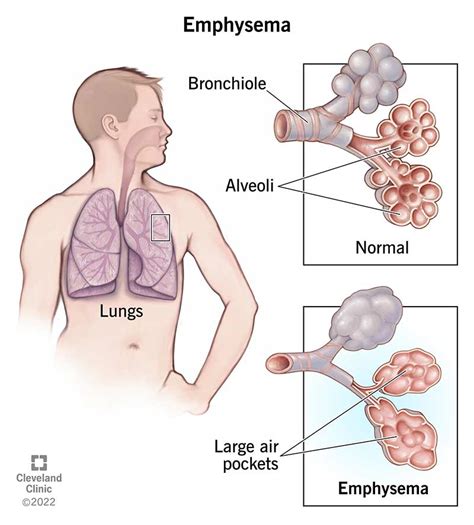 Emphysema Symptoms Stages The Stages Of Copd [9] Download Scientific