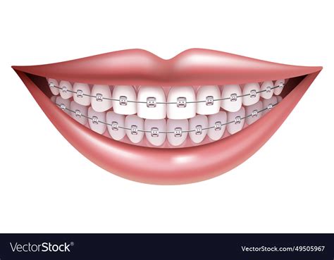 Corrective Orthodontics Examples At Inez Woodford Blog