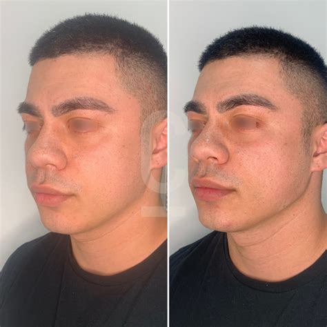 Chin Fillers Sydney Non Surgical Injections