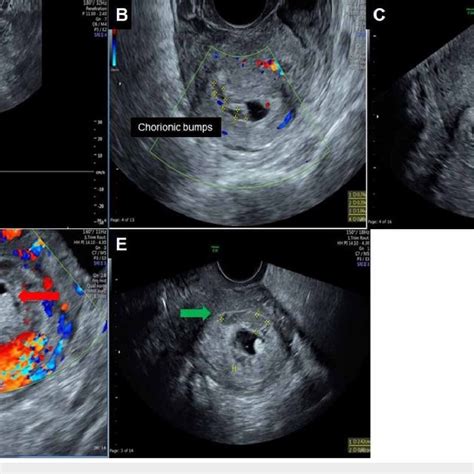 Pdf Chorionic Bump Radiologic Features And Pregnancy Outcomes