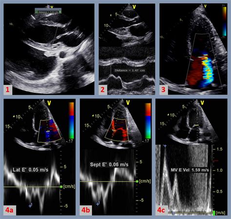 Dilated Cardiomyopathy Echo