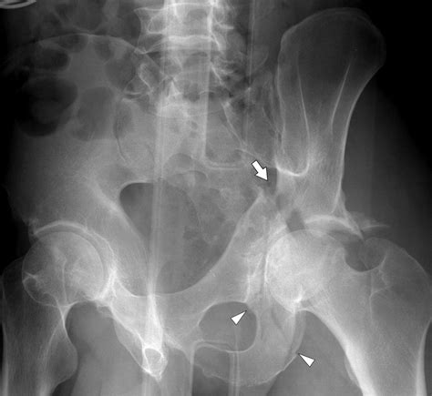 Classification Of Common Acetabular Fractures Radiographic And Ct
