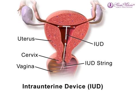 IUD sebagai Pilihan Alat Kontrasepsi Efektif