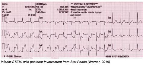 Abnormal 12 Lead Ecg