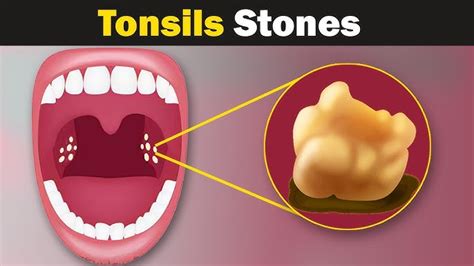 Tonsillectomy Healed Wrong