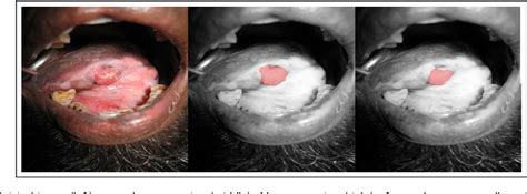 Figure 6 From Deep Convolutional Neural Network Algorithm For The Automatic Segmentation Of Oral