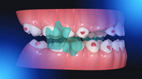 Premium Class Ii Correction Using Invisaligns Ma Appliance