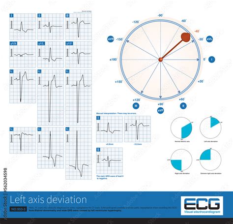 This Is An Electrocardiogram Of Left Ventricular Hypertrophy With Left Axis Deviation The QRS