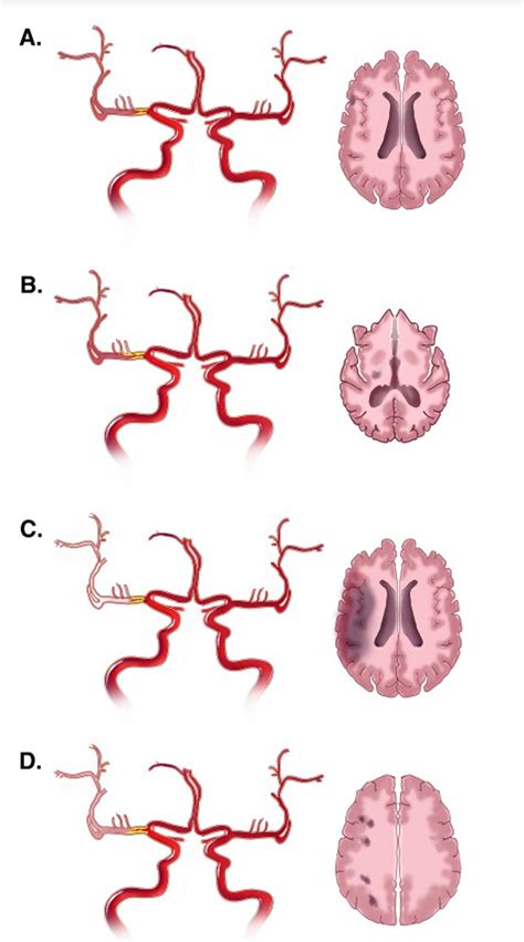 Intracranial