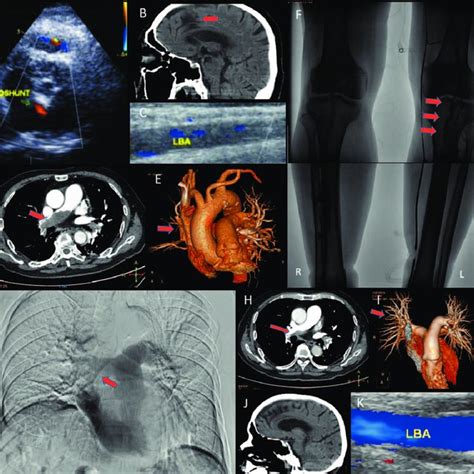 Imaging Findings Of Case 1 A Tte Showed An Atrial Septal Defect