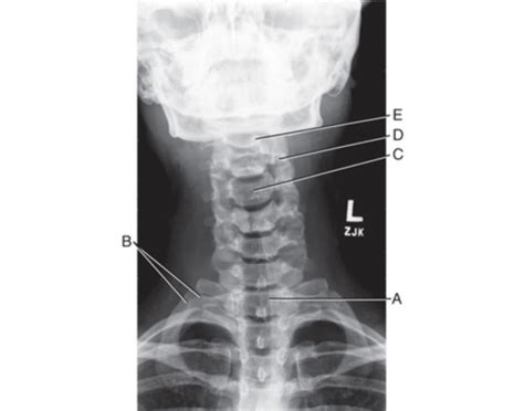 Ap Cervical X Ray Quiz