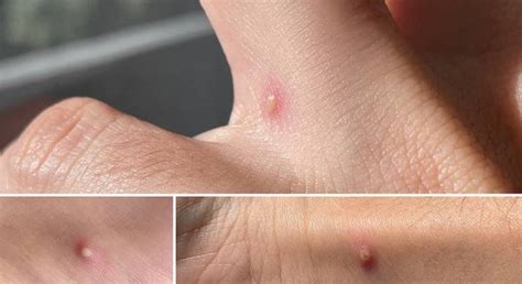 Varíola Do Macaco Pode Se Tornar Endêmica No Brasil Por Falta De Plano